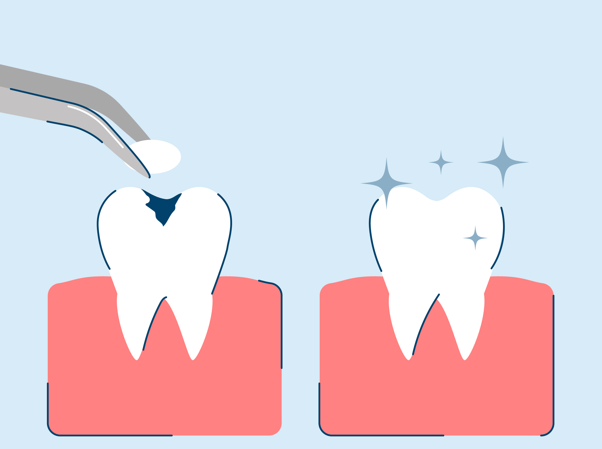 Cavity Filling 101: What to Expect, Procedure, and Costs | SNOW® Oral Care