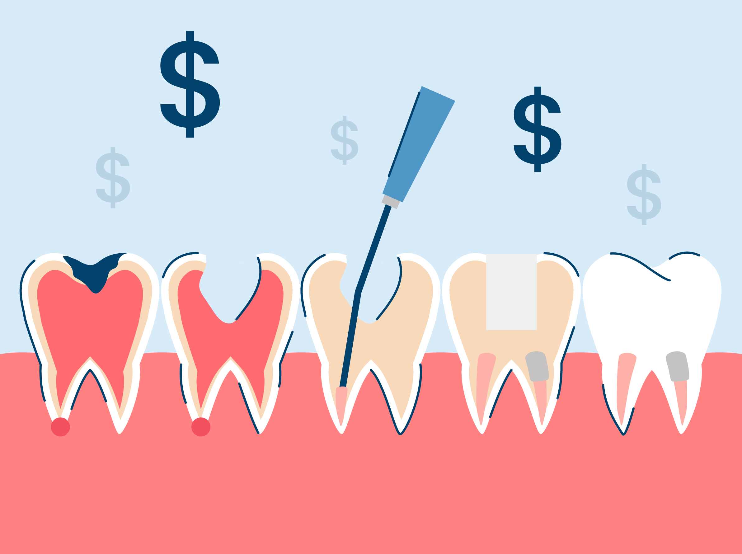 How Much Does a Root Canal Cost?