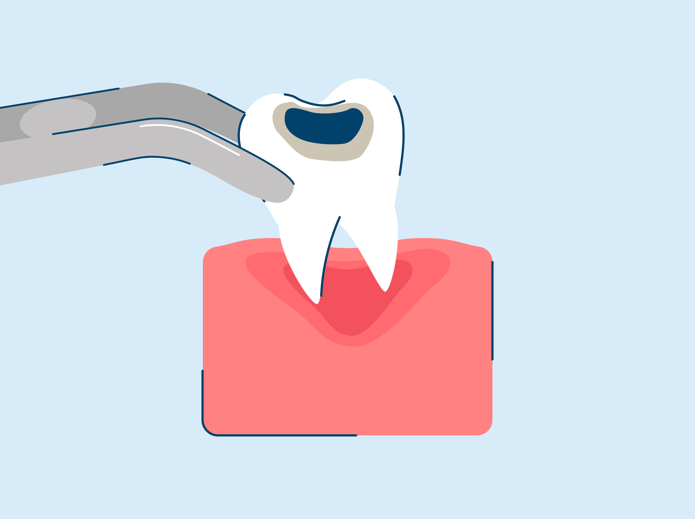 Tooth Extraction: Procedure, Aftercare, and Recovery