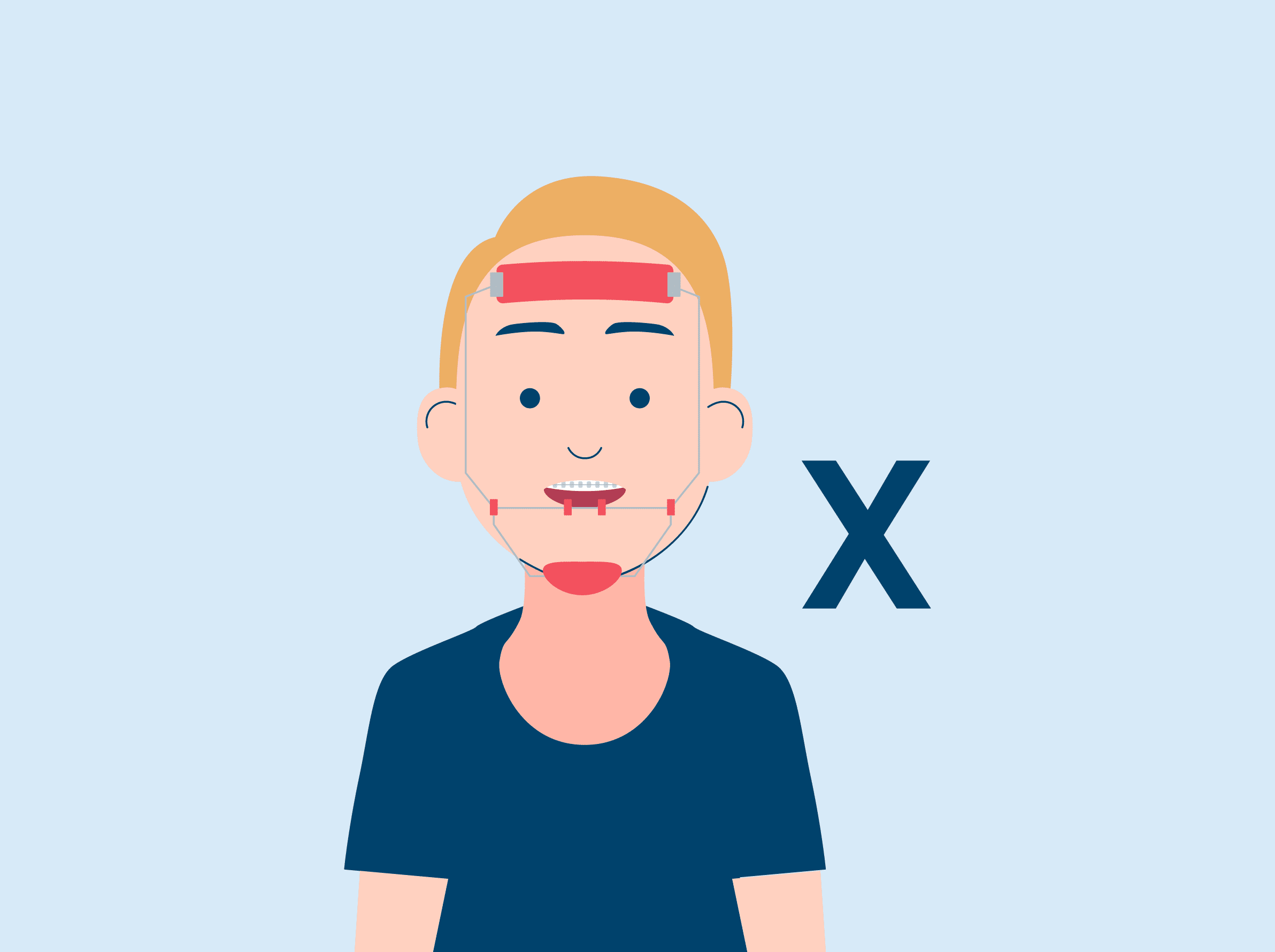 3 Types of Orthodontic Headgear for Underbite