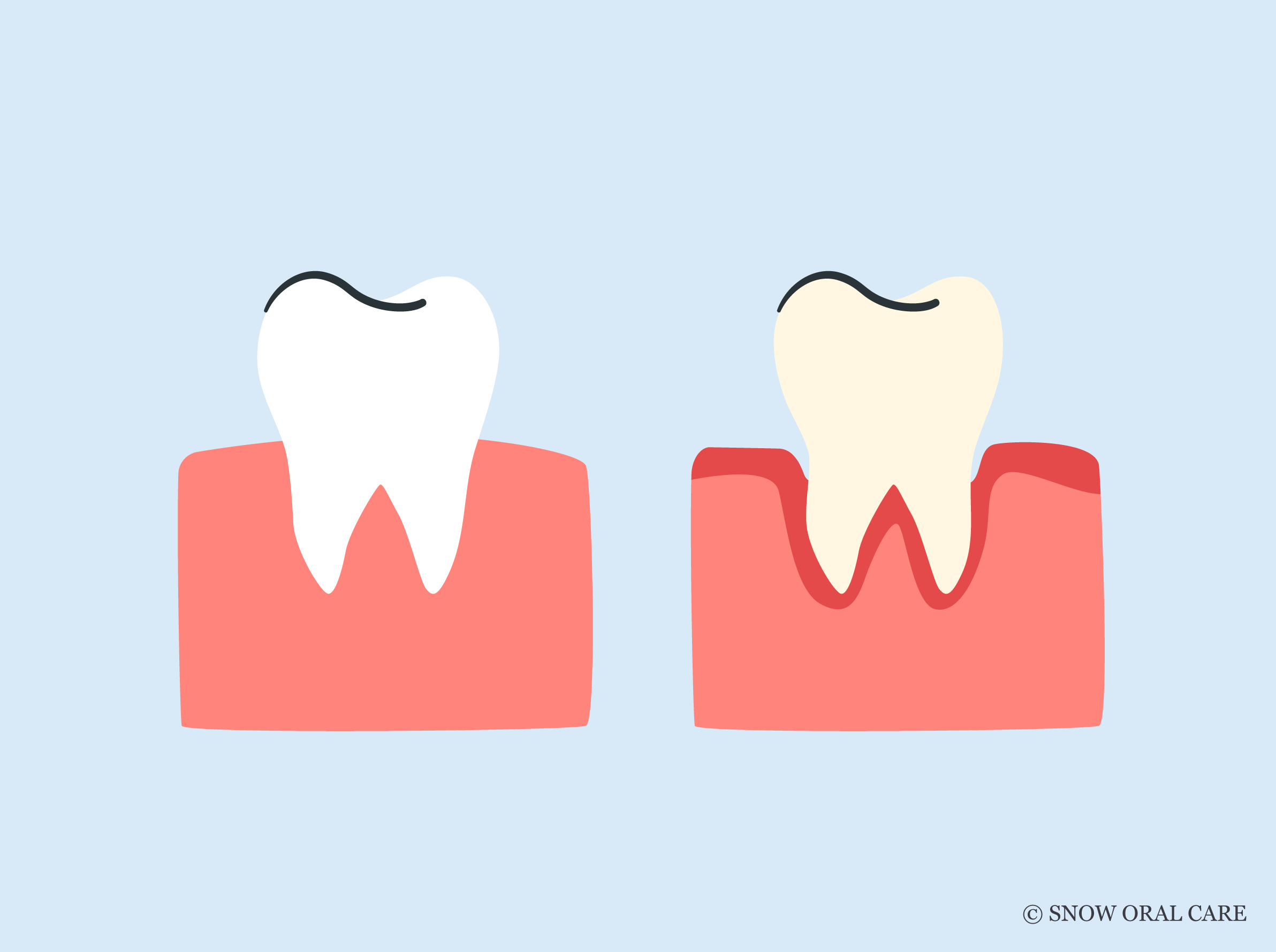 Best Toothbrush for Periodontal Disease: SNOWs Top Pick – SNOW® Oral Care