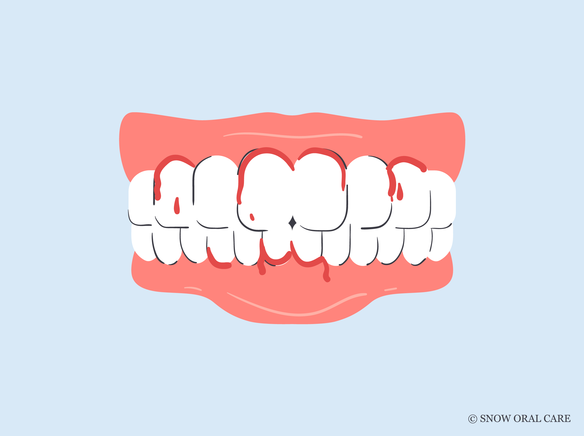 Blood Stains on Teeth? Try These DIY Whitening Hacks!