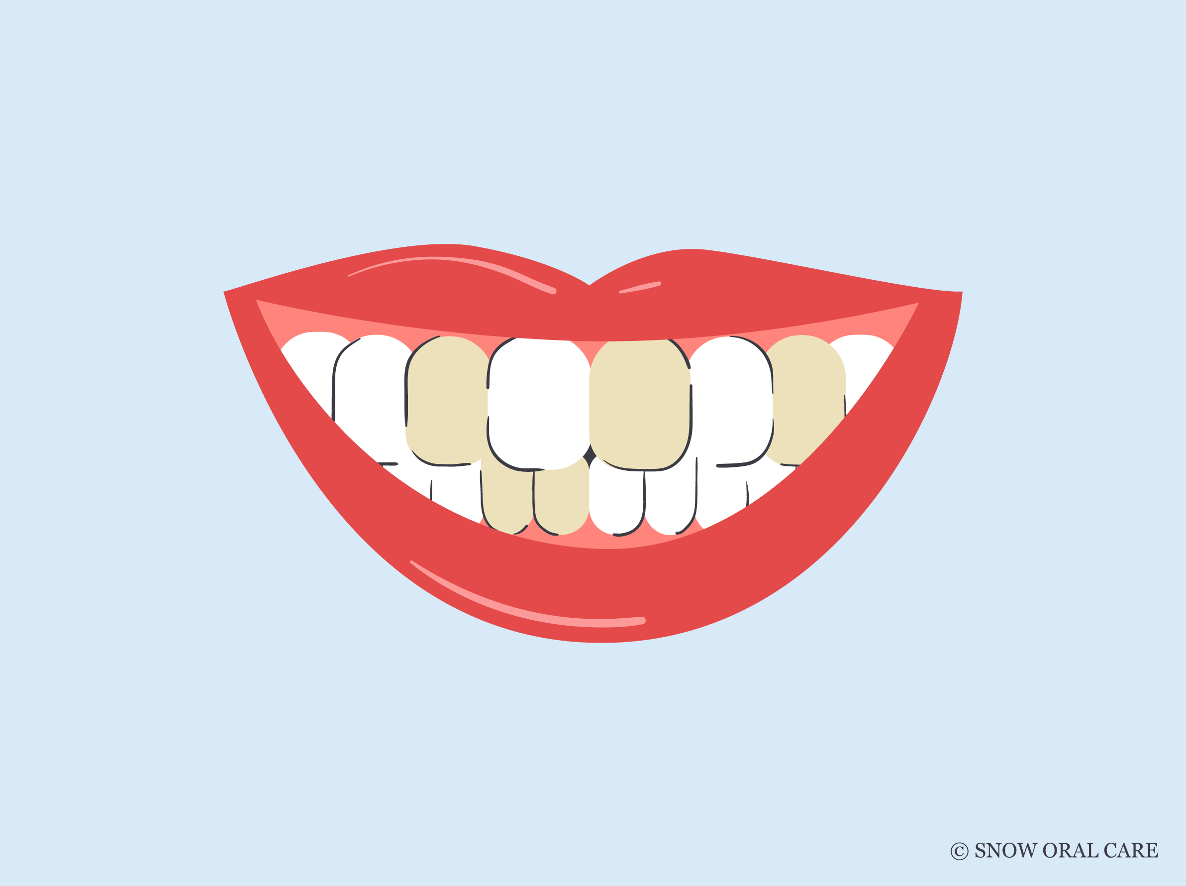 Brown Teeth Causes: Home Whitening Guide!