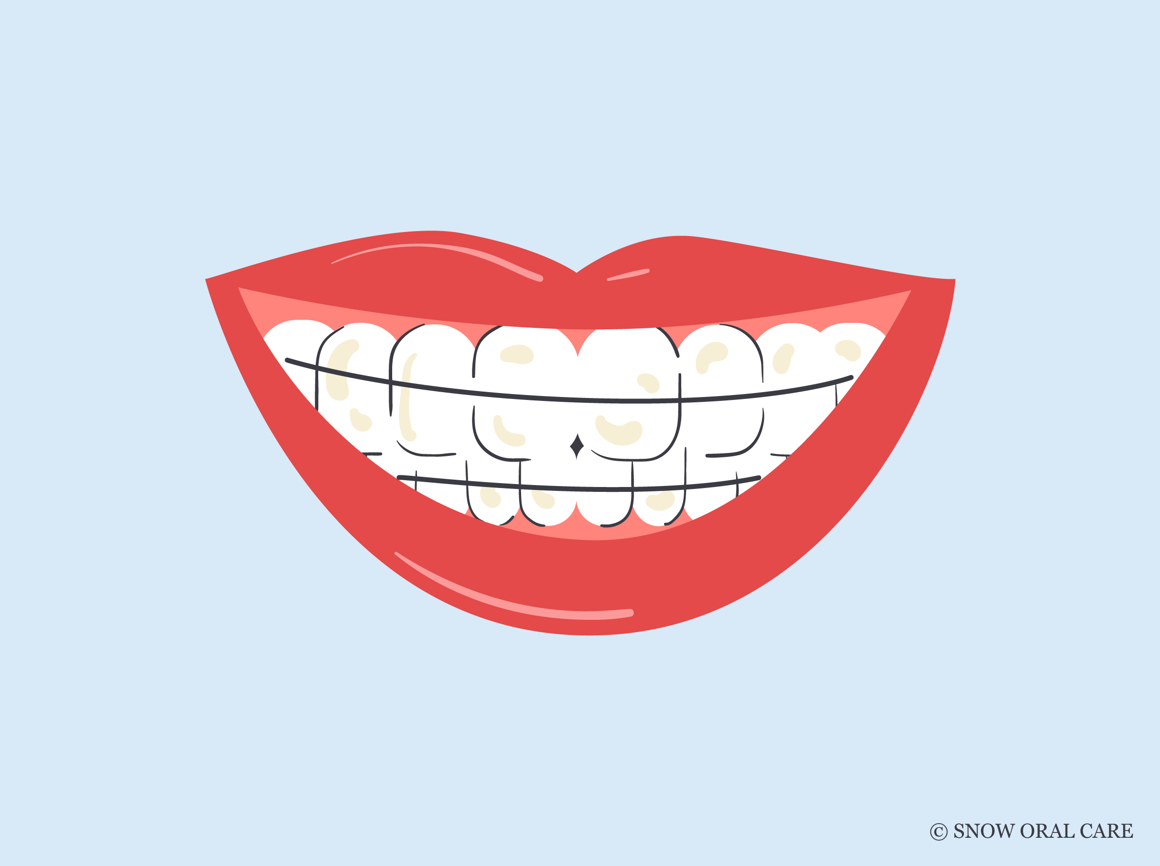 Can a Retainer Stain Your Teeth? Whitening Hacks Inside! – SNOW® Oral Care