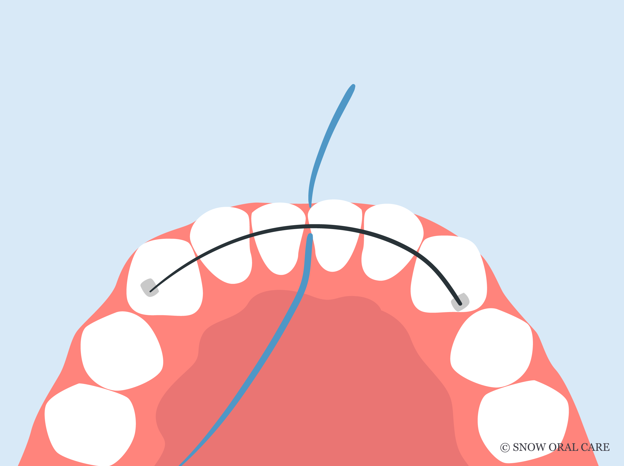 How to Floss Under Permanent Retainer Without Threader: Tips – SNOW ...