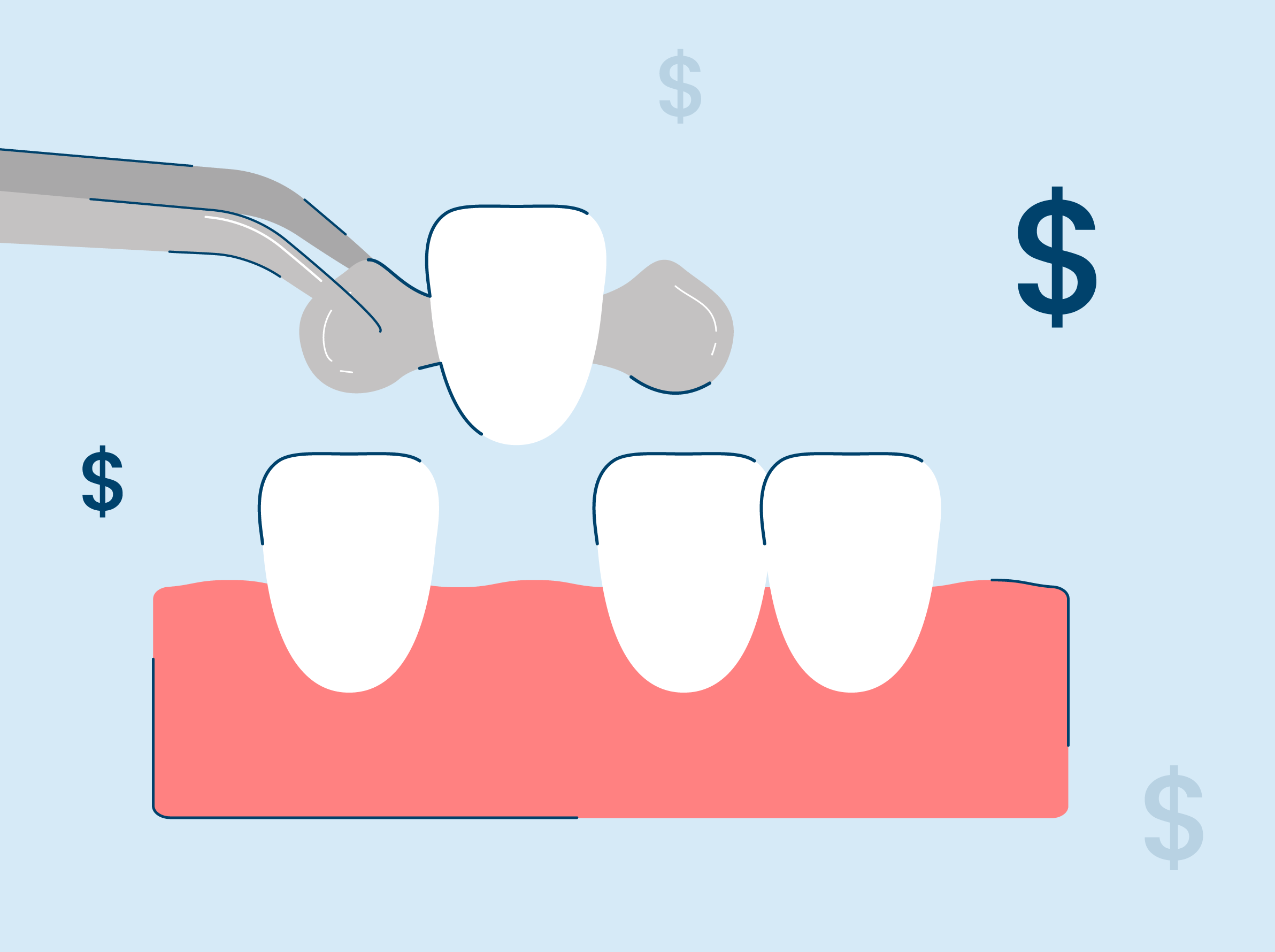 What is a Maryland Bridge?