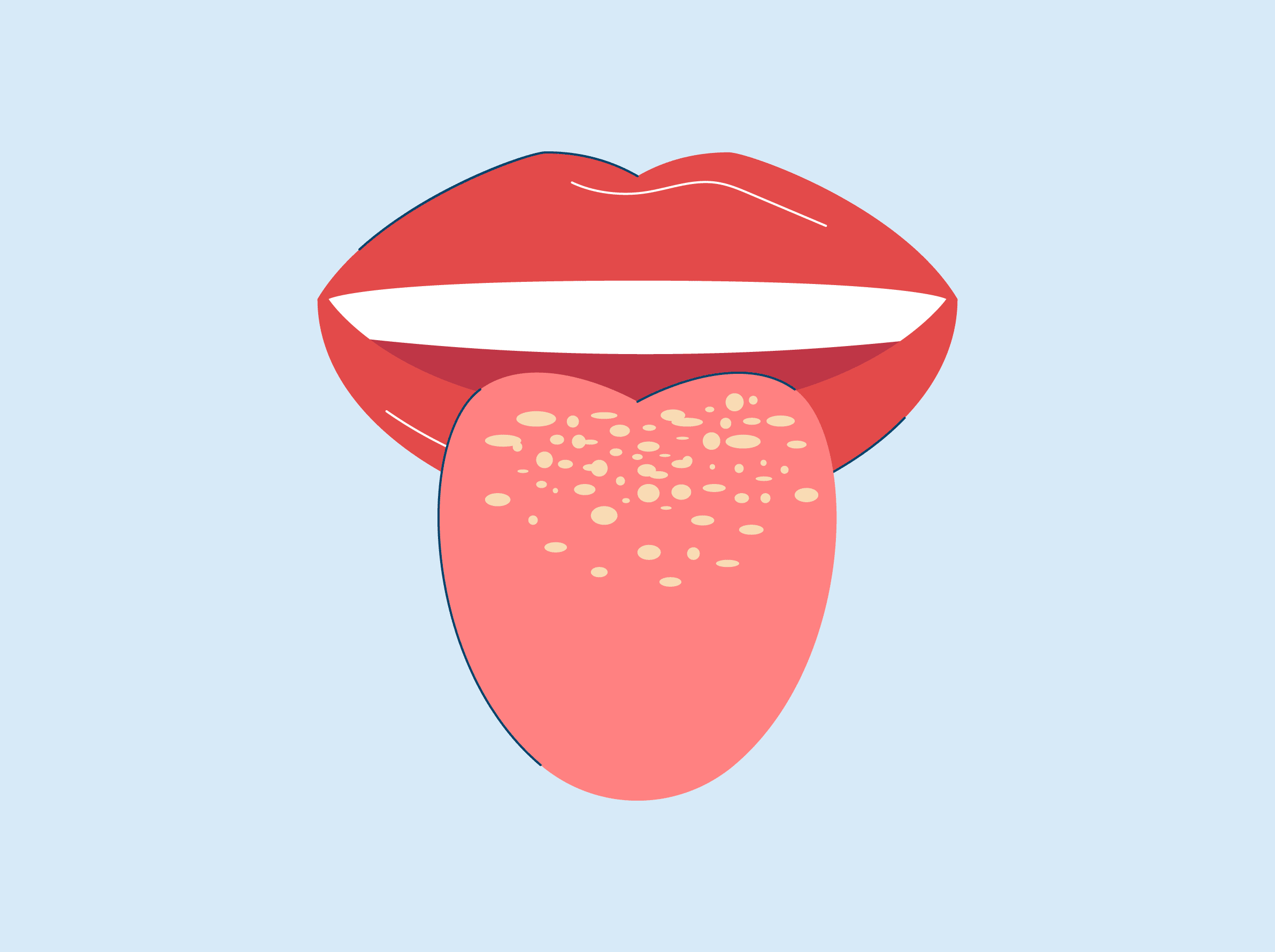 How to Prevent Oral Thrush (Oral Candidiasis)