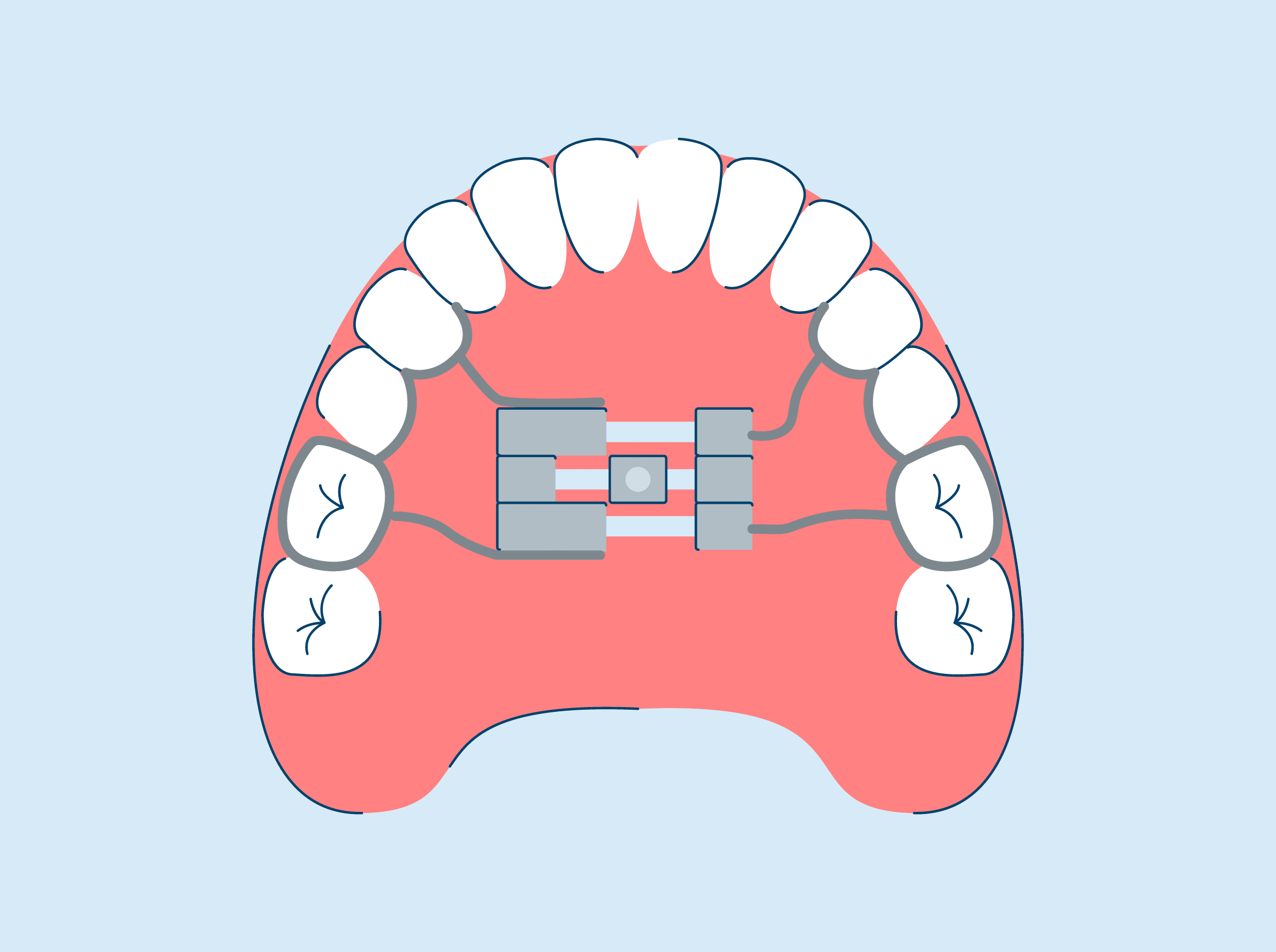 Palate Expanders: Types, Uses, Adjusting, and Care | SNOW® Oral Care