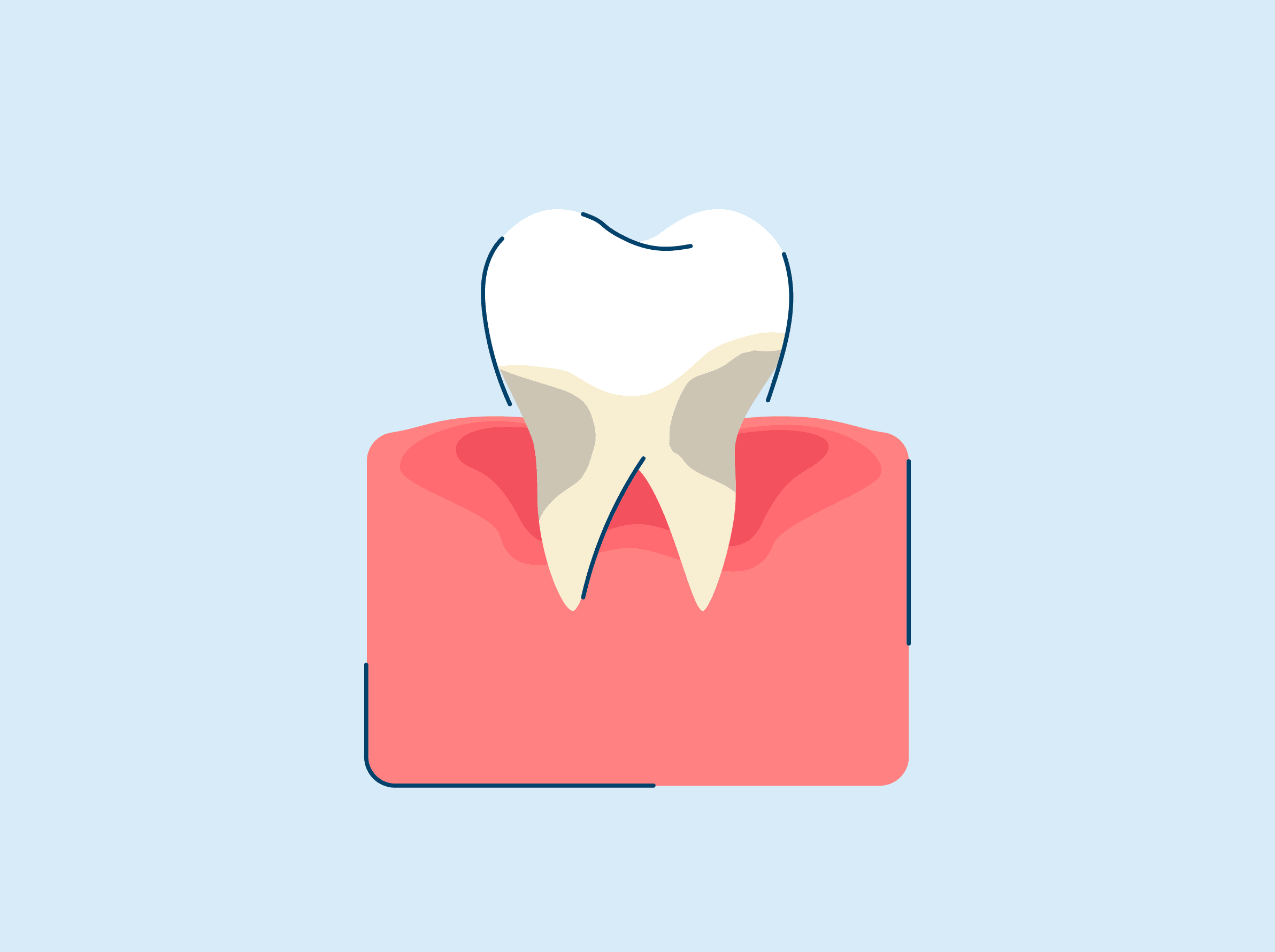 Periodontitis: Symptoms, Causes, and Treatments