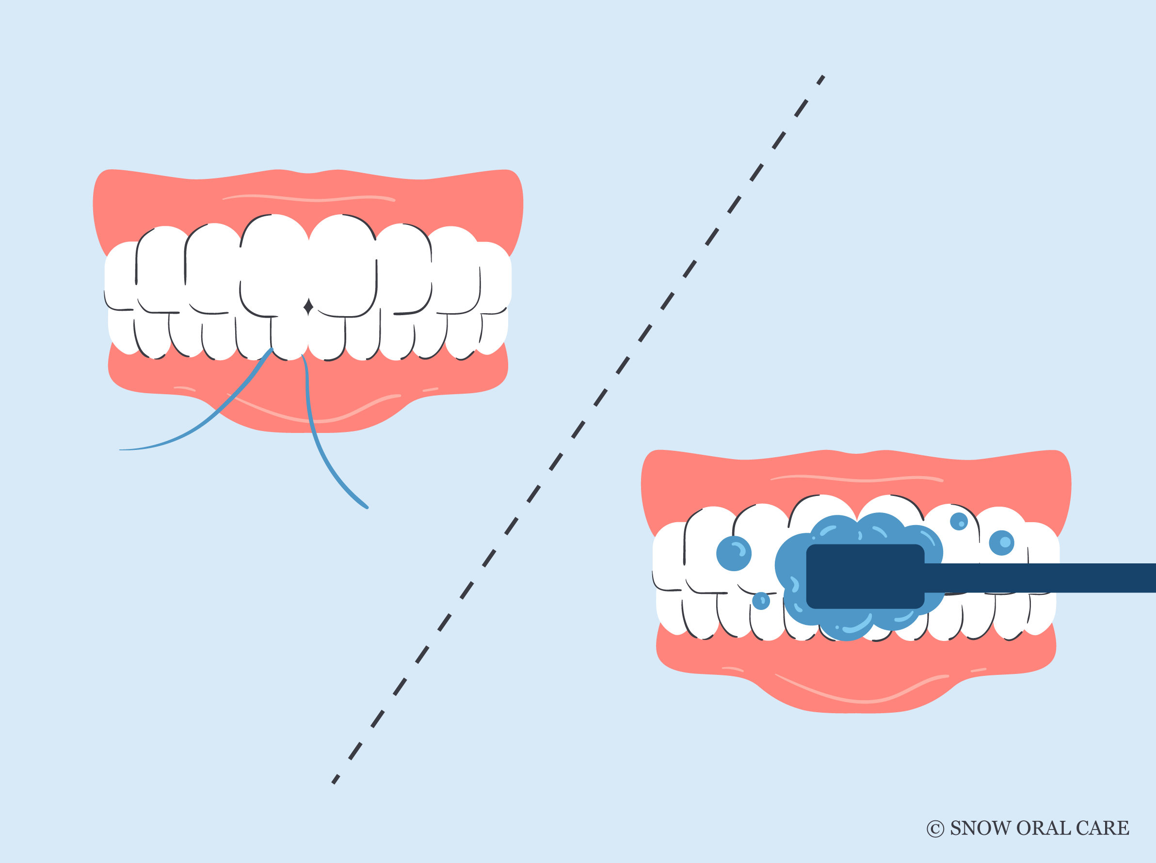 Should You Brush or Floss First ADA | SNOW® Oral Care