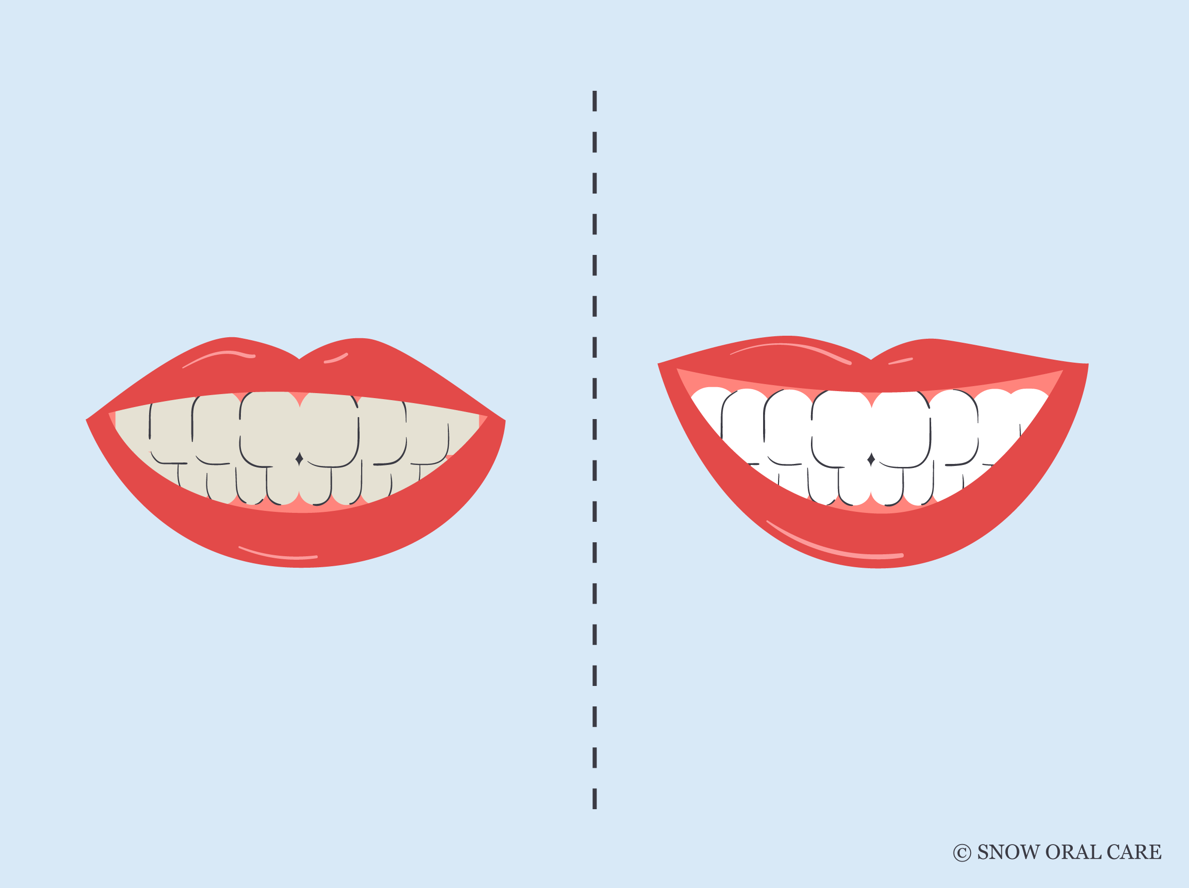 Teeth Whitening Before and After: Real People, Real Results – SNOW ...