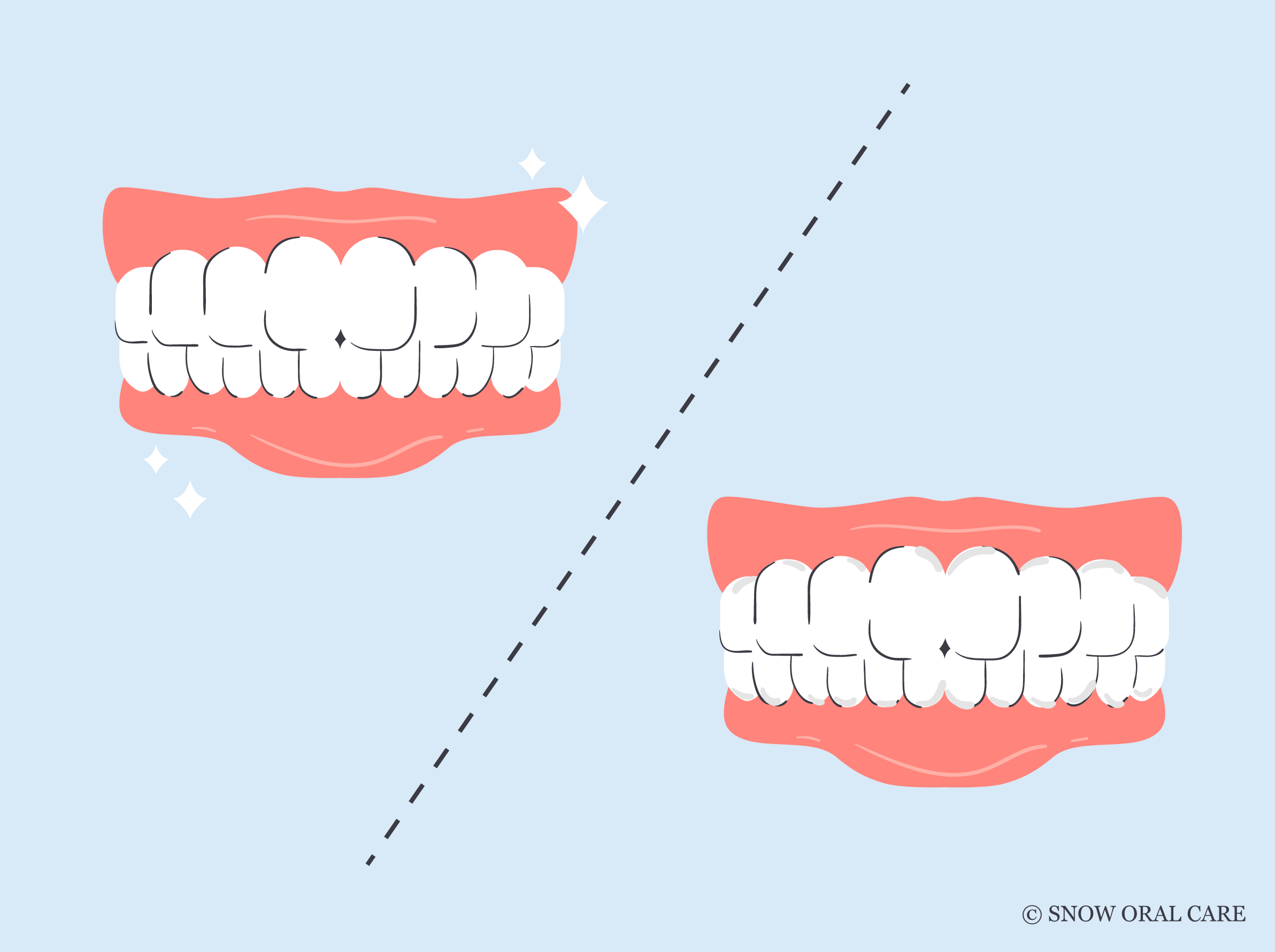 What Happens If You Dont Floss? Primary Health Concerns – SNOW® Oral Care