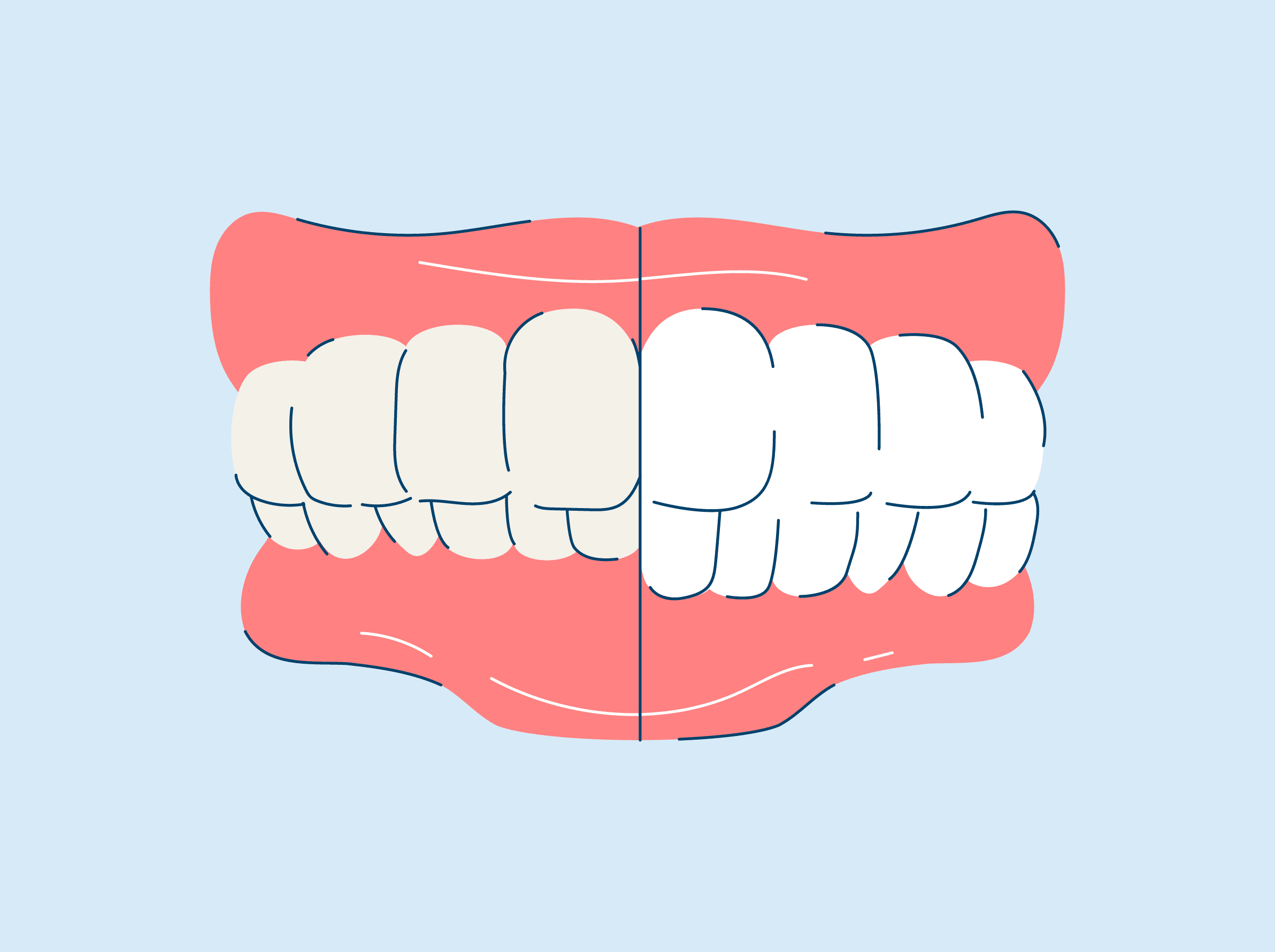 How to Fix Overbite Teeth