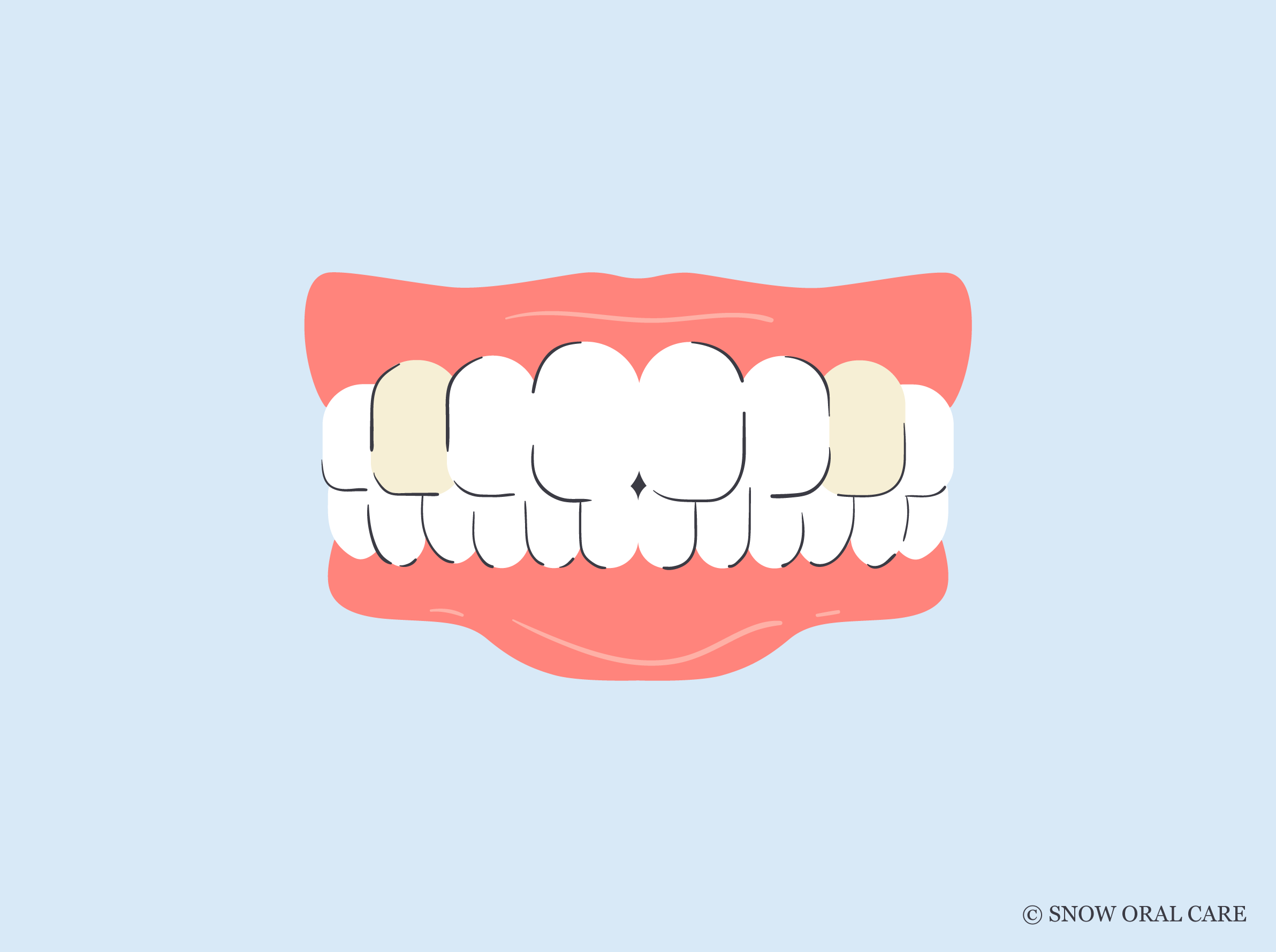 Why Are My Canine Teeth Yellow? DIY Whitening Tips!