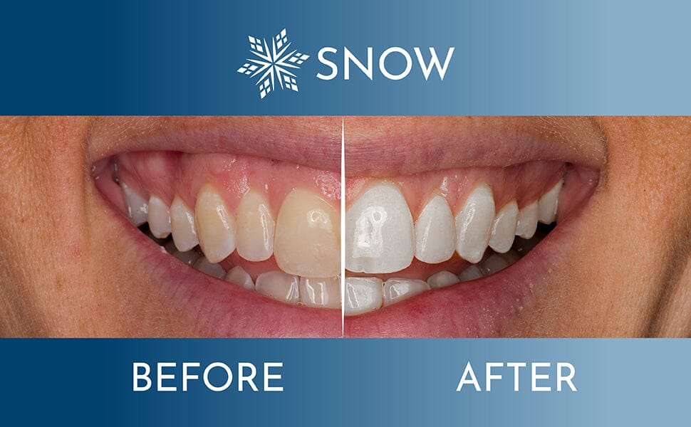 SNOW® Teeth Whitening Kits, Toothpaste, Strips & Electric Toothbrush